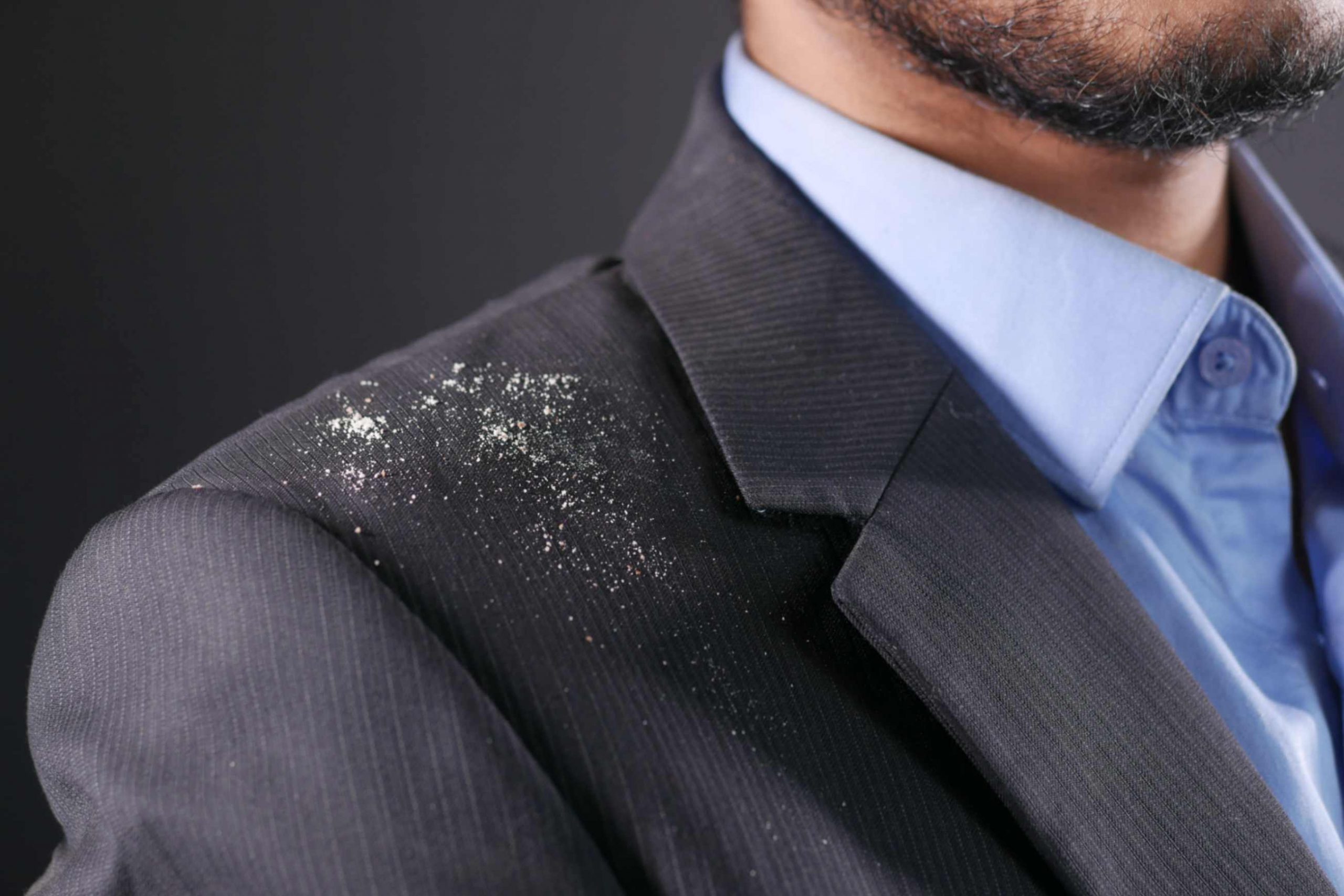 How to Identify and Treat Different Types of Dandruff