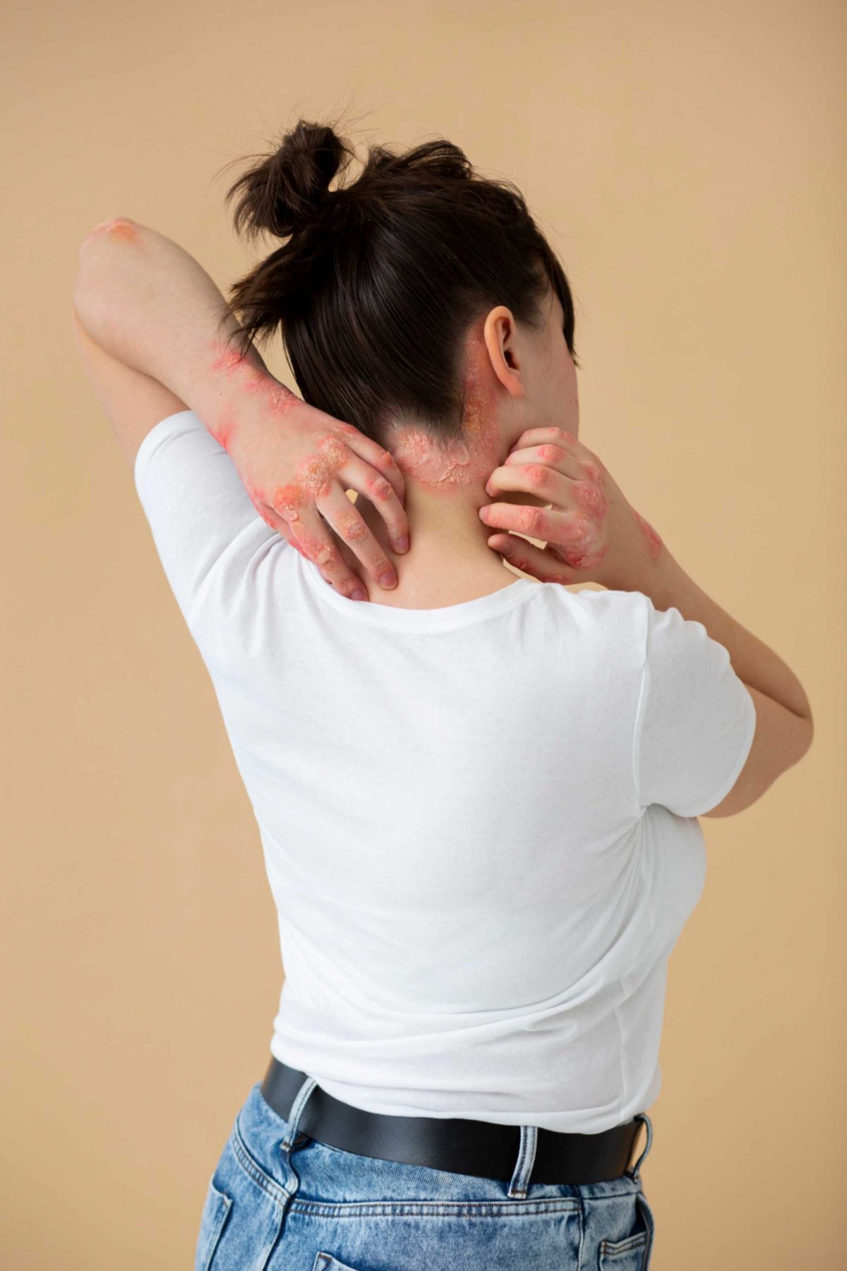 How to Use Apple Cider Vinegar for Psoriasis