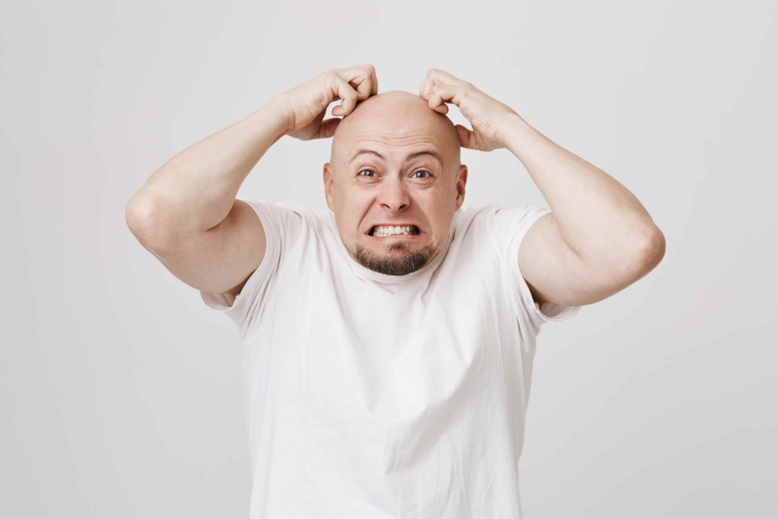 7 Stages of Male Pattern Baldness