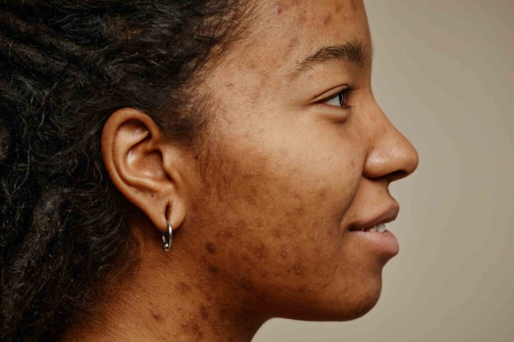 Fading Foes: Acne Marks vs. Acne Scars Explained
