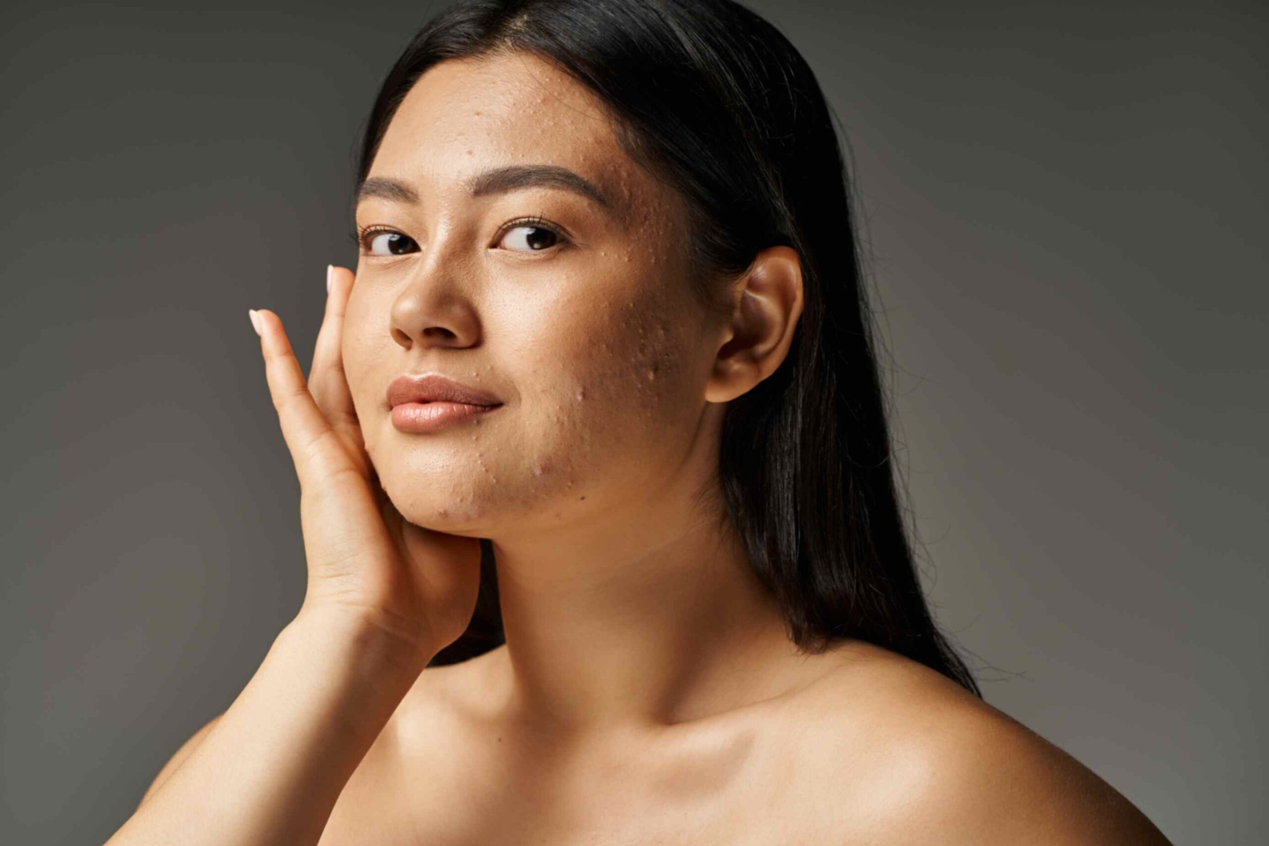 6 Easy Ways to Keep Your Skin Clear and Acne-Free