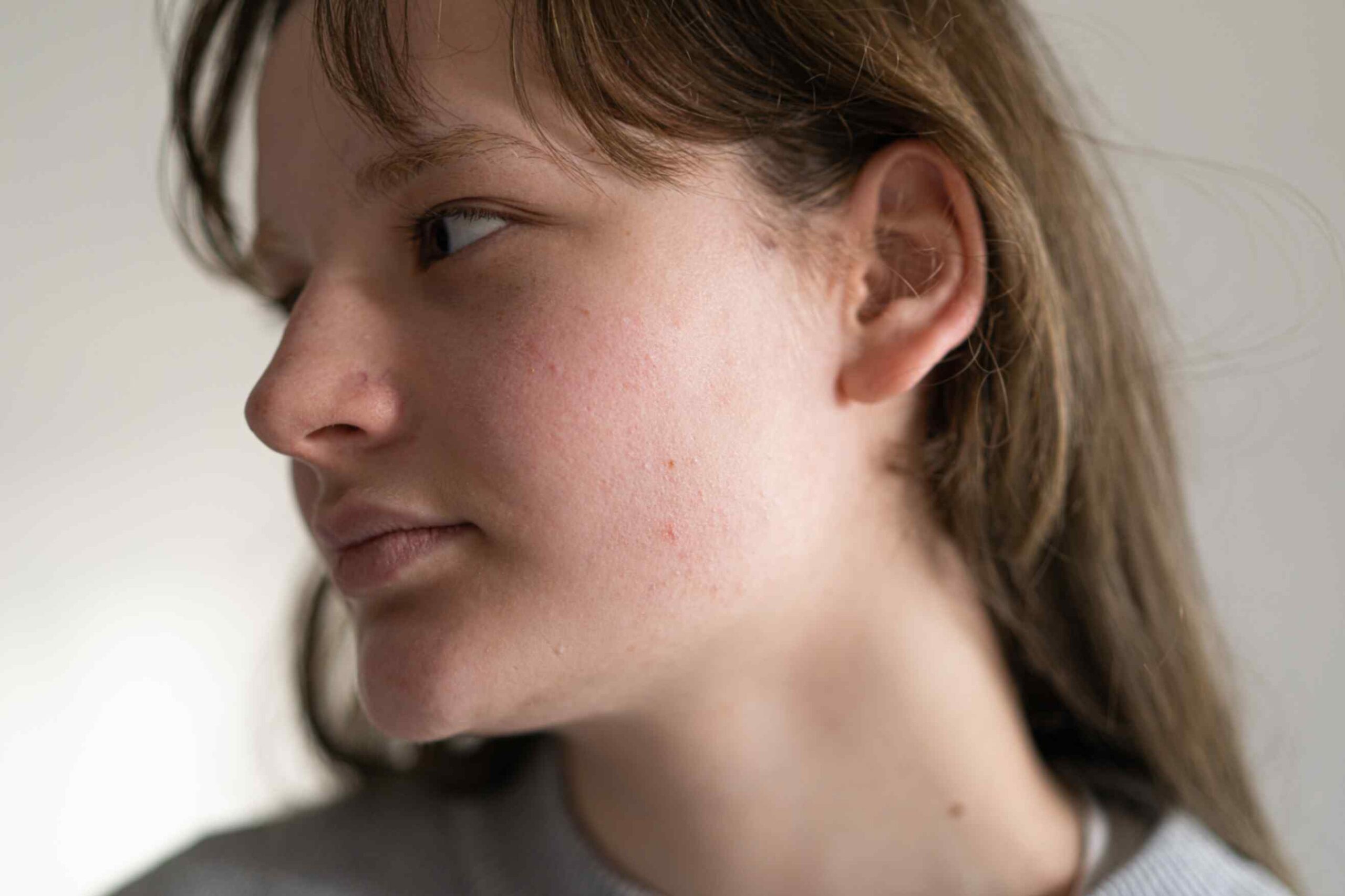 What Are Blemishes, and How Can You Get Rid of Them?