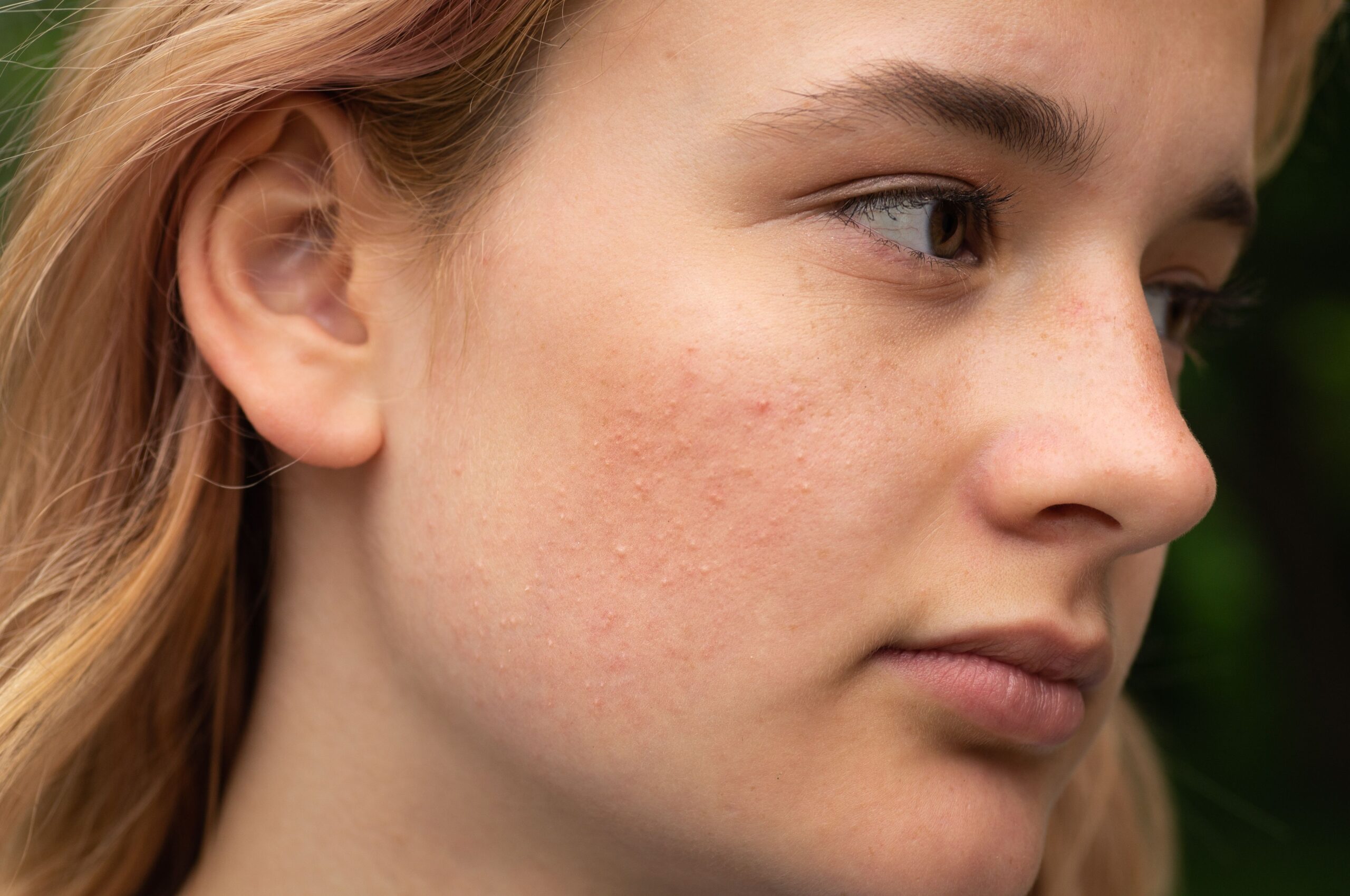 What Are Blemishes, and How Can You Get Rid of Them? | Buy Wow