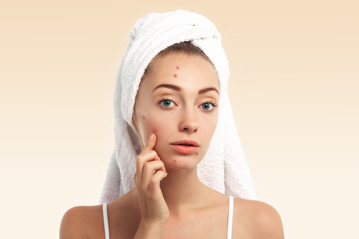 Acne vs. Pimples: What’s the Real Difference and Why It Matters | Buy Wow